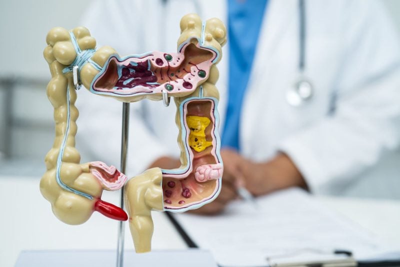 Colon Polyps Found? Exploring Outpatient Endoscopic Resection Options ...